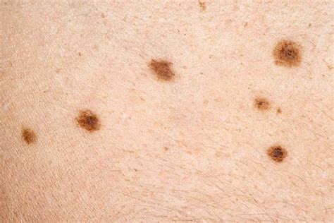 Información básica sobre el cáncer de piel CDC