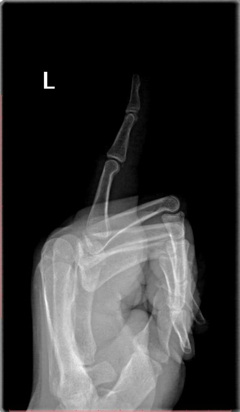 Finger Joint Volar Plate At Ava Ewers Blog
