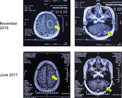 Brain Metastases Completely Disappear In Non Small Cell Lung Cancer Us