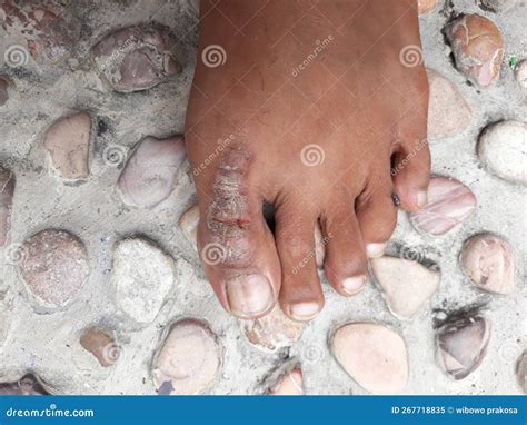 Psoriasis Eczema Dermatitis On The Big Toe Stock Image Image Of