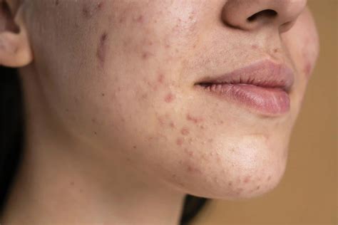 10 Tips To Control Oily And Acne Prone Skin Loccitane Indonesia