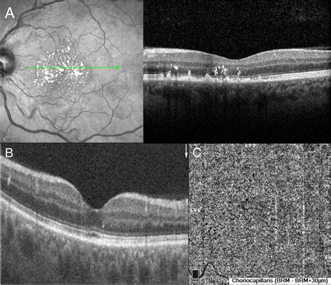 Exams At Follow Up A Ss Oct Scan At 2 Months Shows Complete Download Scientific Diagram