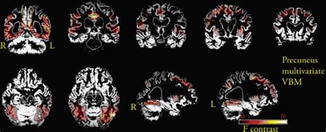 Precuneus Atrophy In Early Onset Alzheimers Disease A Morphometric