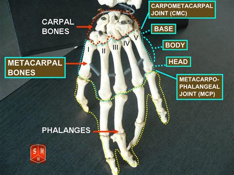 Fifth Metacarpal Neck Fracture Rxharun Fifth Metacarpal Neck Fracture Rxharun