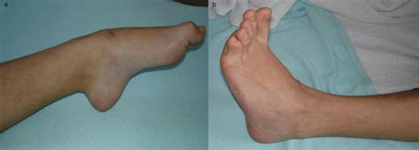 Novel Use Of Intrathecal Baclofen Drug Delivery System For Periodic