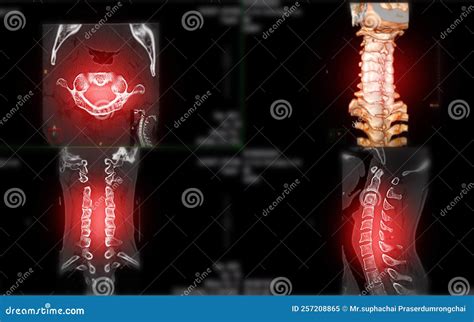 Cervical Fracture And Human Spine And Vertebrae Damage Outline Diagram