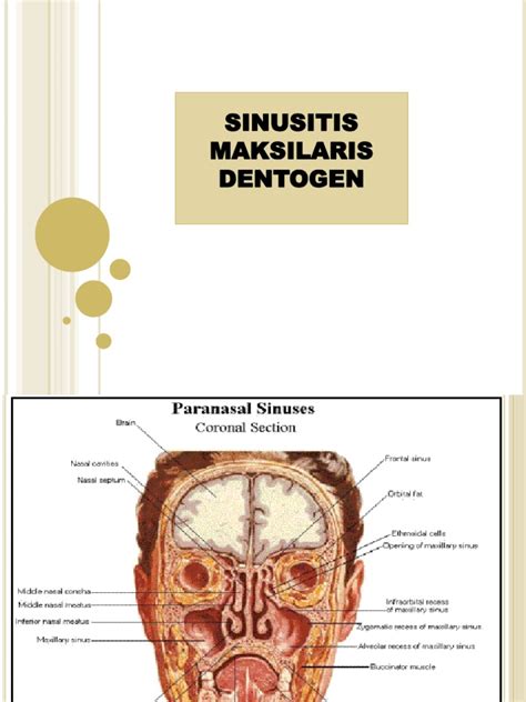 Sinusitis Pdf Kajian Bahasa Asing Kesehatan Holistik