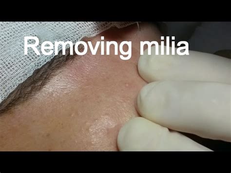 Treating Milia On Lips