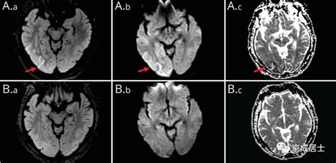 《neurology》教学神经影像：高血糖诱发的枕叶癫痫腾讯新闻