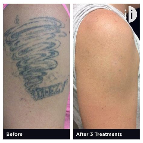 Invisible Invisible Ink Tattoo Removal Before And After