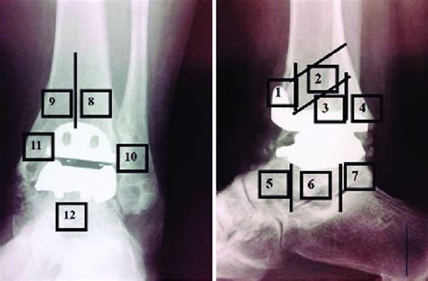 Osteolytic Zones In The Tibia And Talus According To Gruen And