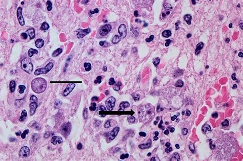 Deadly Amoebic Encephalitis And Brain Eating Amoebas In The Crosshairs