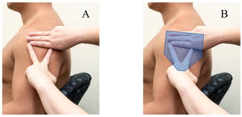 Shoulder Injury Related To Vaccine Administration Sirva Is Real A