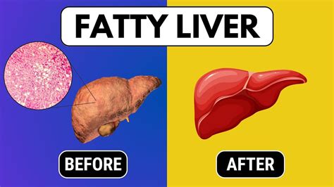 Strictly Avoid These 5 Foods If You Have Fatty Liver Fatty Liver