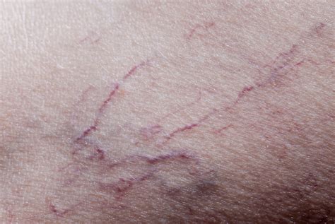 Red Lines Appear On Skin