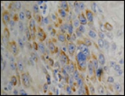 High Bax Cytoplasmic And Nuclear Membrane Staining In Low Grade