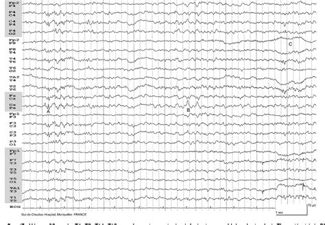 Figure 2 From Phantom Spike And Wave Bursts During Rem Sleep Semantic