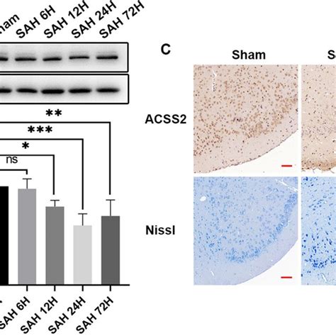 Temporal Expression Of Acss2 In Primary Cortical Neurons Exposed To
