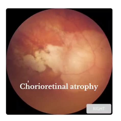 An Noor Eye Hospital On Linkedin Chorioretinal Atrophy