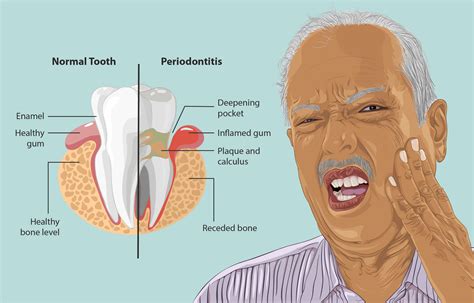 PERIODONTITIS A COMMON DISEASE