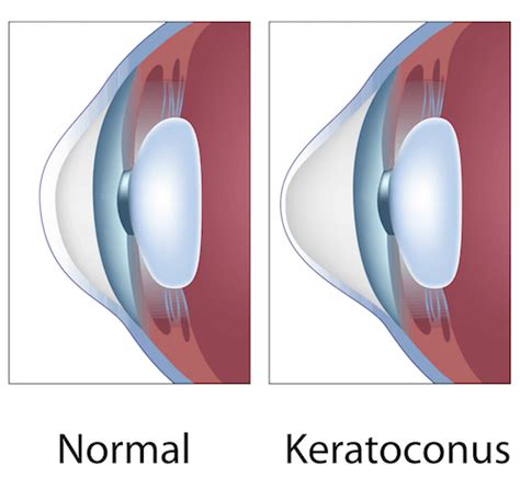 Keratoconus And Cxl Dr Chameen Sams
