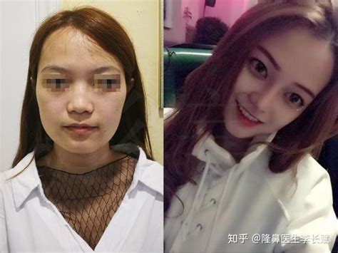 用耳软骨隆鼻效果好吗？会不会全部吸收？ 知乎