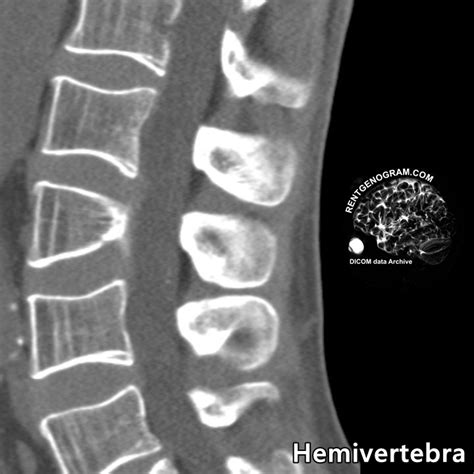 Dicom Spine Anomaly
