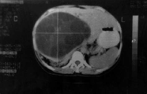 Computed Tomographic Ct Scan Displays A Large Hydatid Cyst In The