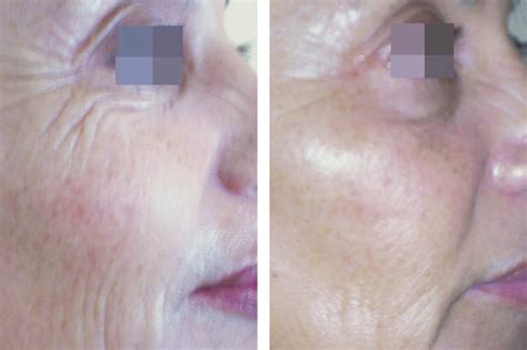Indiba Facial Corporal Y Capilar Mirets Estetica Y Masaje