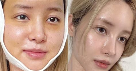 윤곽 수술 유깻잎 퉁퉁 부은 얼굴에 멍 가득…충격적 비포 애프터