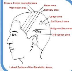 Scalp Acupuncture Therapy In Mumbai ID