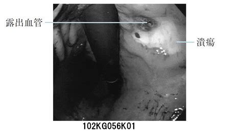 102g56 消化性潰瘍 国試 テコプラ