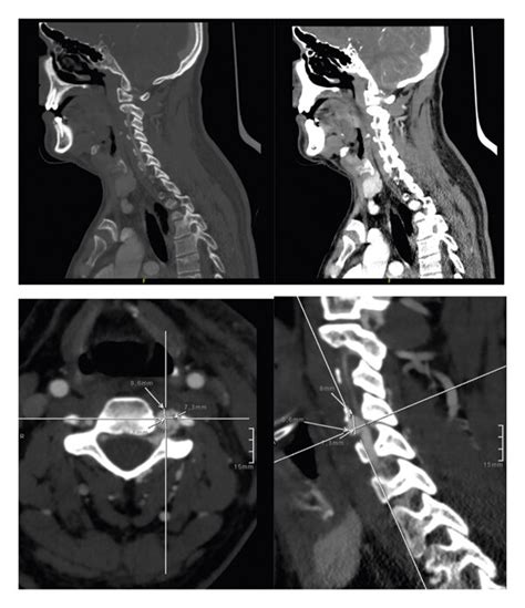 Angiography Of The Head And Neck Vessels A Pseudoaneurysm Of The Left