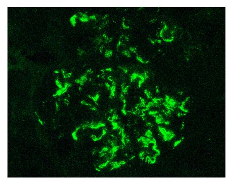 Iga Vasculitis And Iga Nephropathy Same Disease