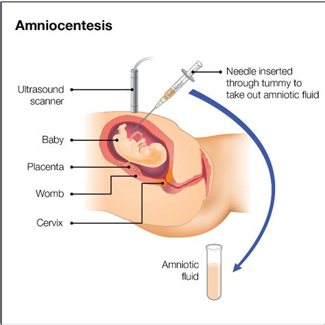 Amniocentesis Primary Care Notebook