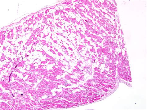 Arrhythmogenic Right Ventricular Cardiomyopathy Histology
