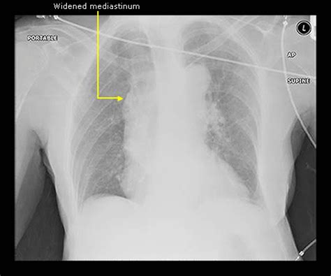 Chest Radiography Rcemlearning