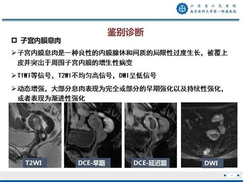 子宫内膜癌FIGO分期与功能磁共振成像 医学界 助力医生临床决策和职业成长