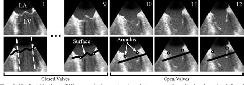 Figure 1 From Mitral Annulus Segmentation From Four Dimensional Ultrasound Using A Valve State