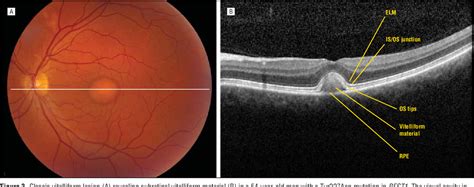 Figure 3 From Three Dimensional Distribution Of The Vitelliform Lesion