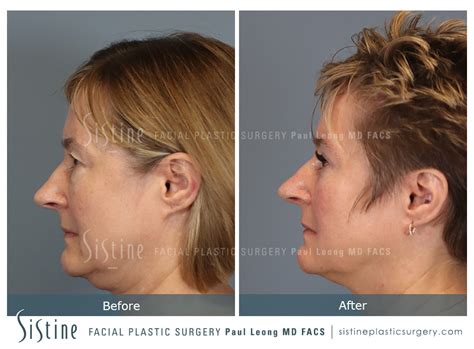 Blepharoplasty Before And After 08 Sistine Facial Plastic Surgery