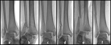 Distal Fibula Fracture Pin On Broken Fibula Exercises