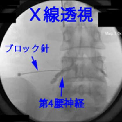 神経ブロックの種類千葉船橋 痛みと多汗症クリニックへ関東千葉