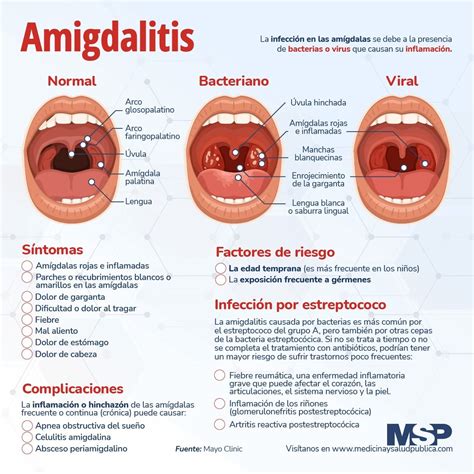 Amigdalitis Infografía Amigdalitis Cosas De Enfermeria