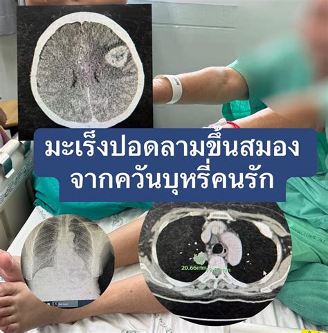 มะเร็งลามขึ้นสมองจากควันบุหรี่คนรัก Smoke Free Zone