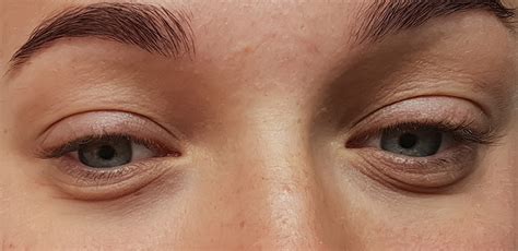 Bags Under Eyes These Are Your Best Bets For Eye Bag Treatment University Health News