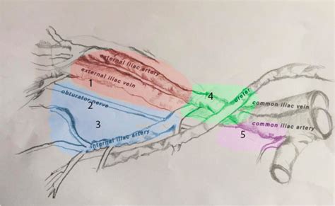Extended Pelvic Lymph Node Dissection During Robotic Prostatectomy Antegrade Versus Retrograde