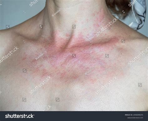 Solar Dermatitis Woman Red Sunburned Skin Stock Photo 2046098255 Shutterstock