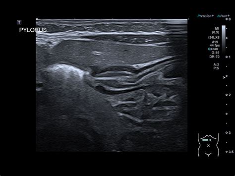 Pediatric Aplio I Series Clinical Gallery Ultrasound Canon