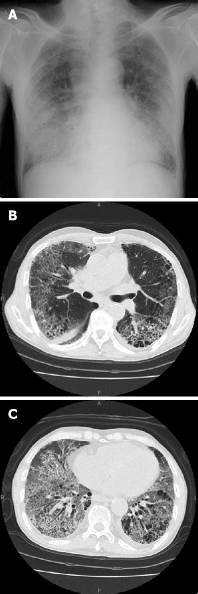 Figure 1 From An Oral Fluoropyrimidine Agent S 1 Induced Interstitial Lung Disease A Case